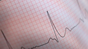 Electrocardiograph (ECG)